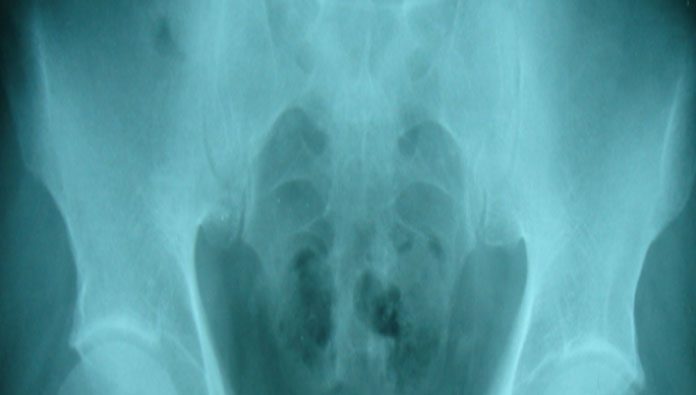 Osteopeni Nedir, Osteoporoz Nedir | Yemek Tarifi, Diyet, Şifalı ...